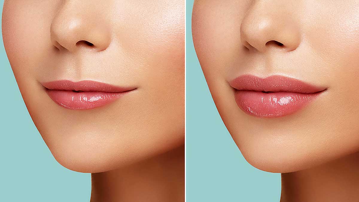 Lip Enlargement for Overall Appearance and Boost Self-Confidence ...